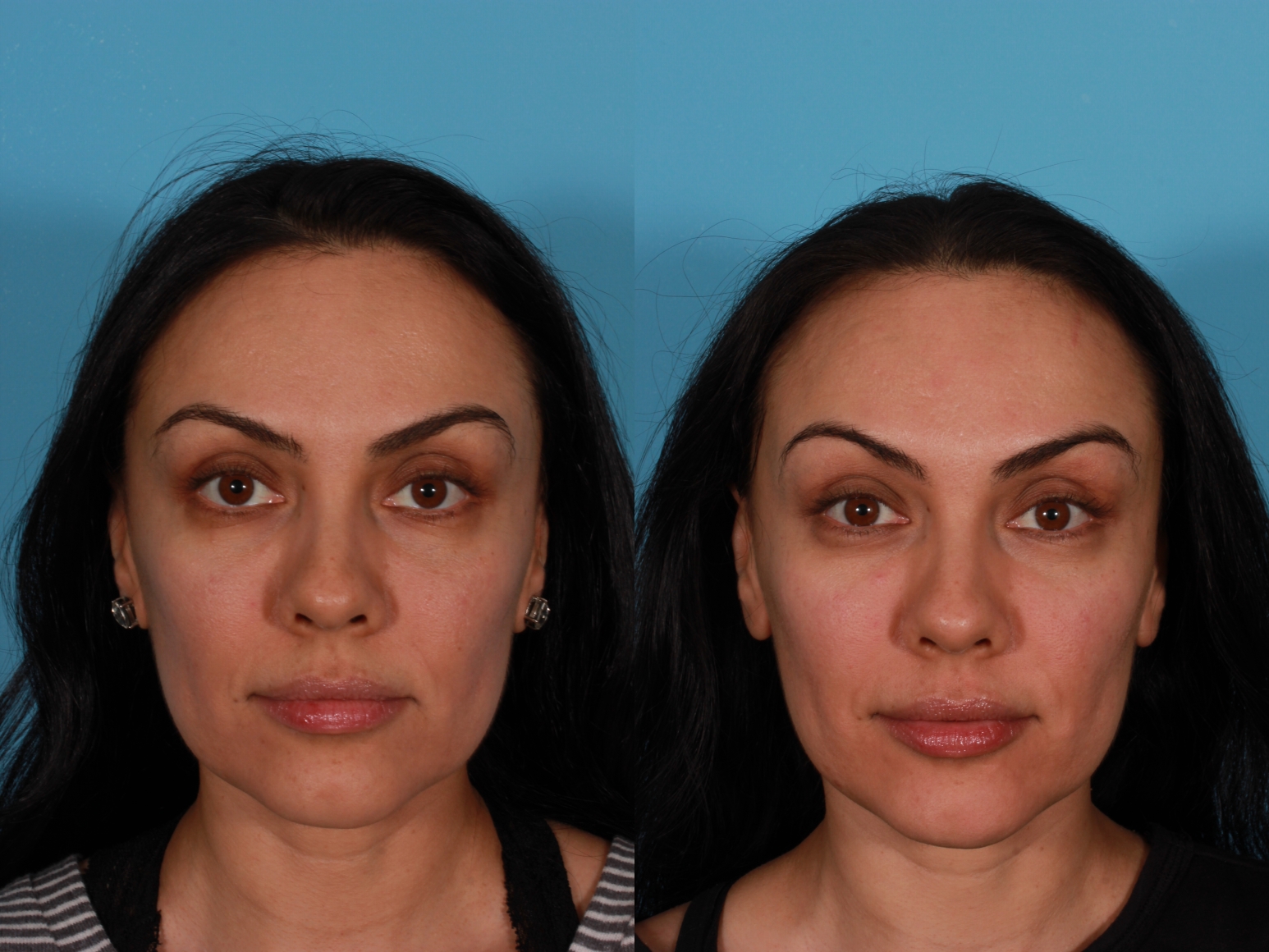 PCA Skin Peel at The Buckingham Center in Austin Tx - AMBER TARR