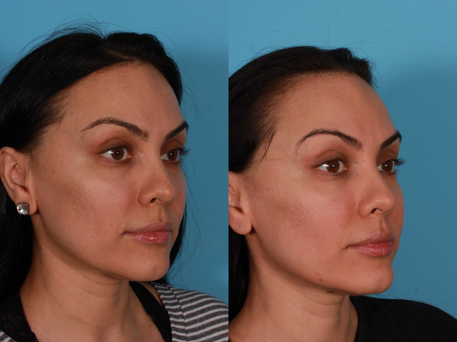 PCA Skin Peel at The Buckingham Center in Austin Tx - AMBERXO